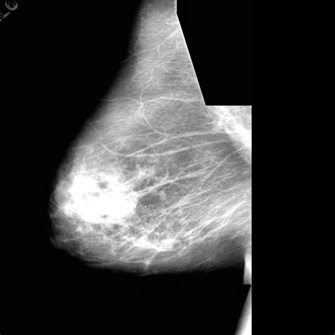 Ddsm Classification Dataset And Pre Trained Model By Lmu