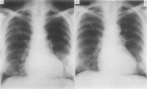Patient 3 Chest Radiographs Before A And After B Methotrexate Download Scientific Diagram