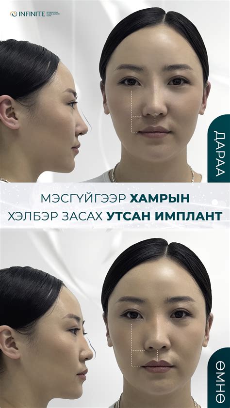 Infinite Clinic Арьс гоо сайхны мэс заслын эмнэлэг ХАМРЫН УТСАН ИМПЛАНТ Хормын дотор гоё