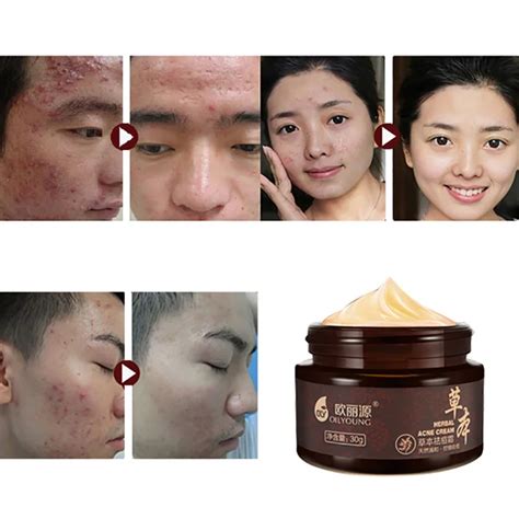 Травяной крем для удаления угрей против прыщей пятен акне крем от шрамов отбеливающий