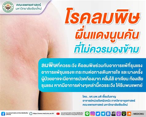 “หมึน” ลมพิษผื่นแดงนูนคัน โรคของผู้ป่วยภูมิแพ้ คณะแพทยศาสตร์ มหาวิทยาลัยเชียงใหม่