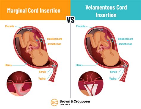 Marginal Cord Insertion Causes Risks Treatment Brown And Crouppen
