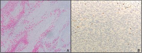 Case 1071 A Woman In Her 50s With A Flank Mass Department Of Pathology