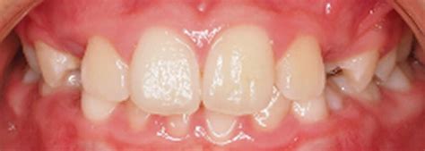 Basic Principles With Aligners Pocket Dentistry