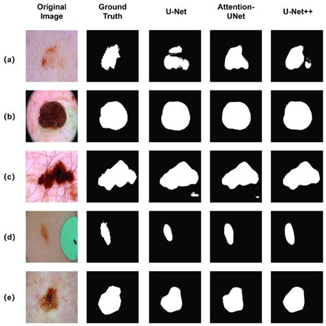 Visual Comparison Of Lesion Segmentation Results Produced By Different Download Scientific