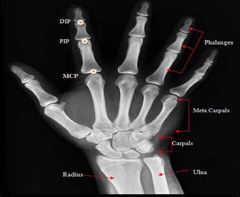 Color Online X Ray Image Of A Human Hand It Shows The Structure Of