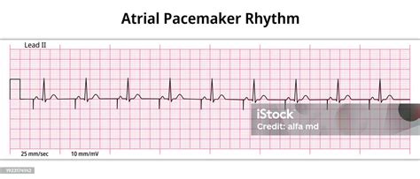 Ecg Atrial Pacemaker Rhythm Single Chamber 8 Second Ecg Paper向量圖形及更多