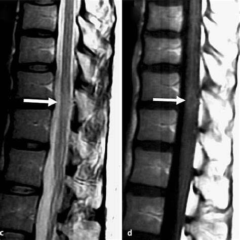 Mri Findings Of The Presented Case Bilateral Hypothalamic Lesions Download Scientific Diagram