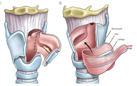 Figure 1 From Vertical Partial Laryngectomy With Temporoparietal Free Flap Reconstruction For