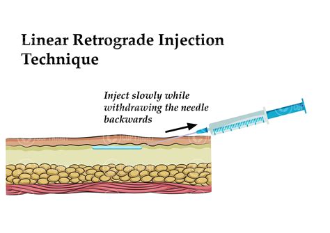 Linear Retrograde Injection Technique Digital Download Nita Mcevoy