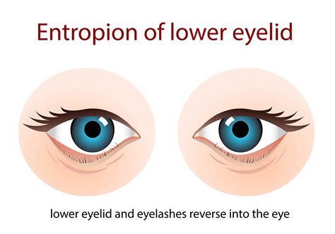 Lid Deformities Entropion And Ectropion Jiva Clinic