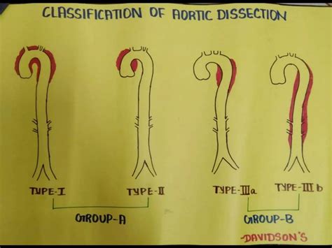 Aortic Dissection Pptx