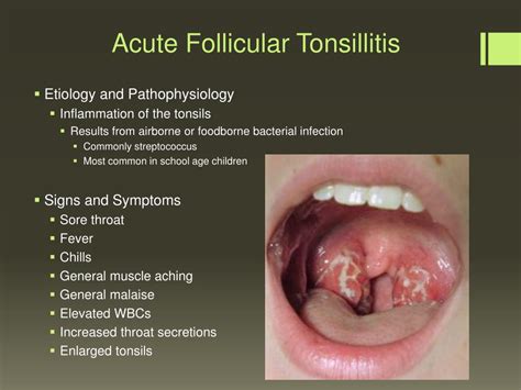 Ppt Disorders Of The Upper Airway Powerpoint Presentation Free