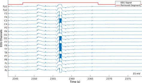 Example Of An EEG Signal Containing A Saturated Segment The Selected Download Scientific