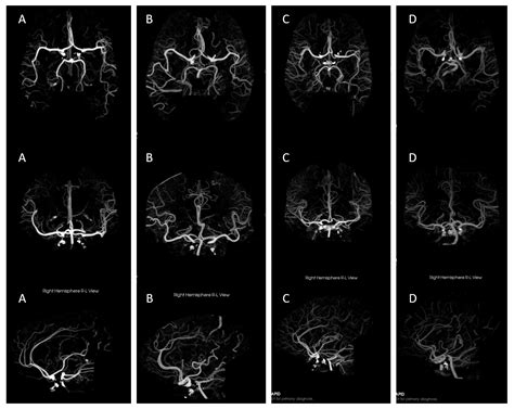 Middle Cerebral Artery