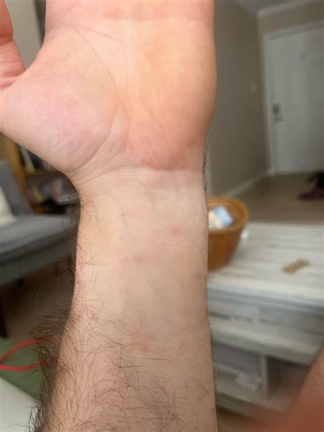 Black Widow Bite First Day