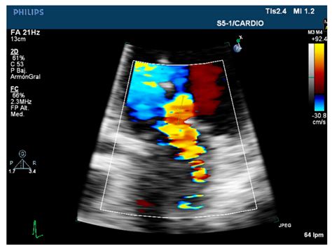 Practical Echocardiographic Approach Of The Regurgitant Mitral Valve Assessment
