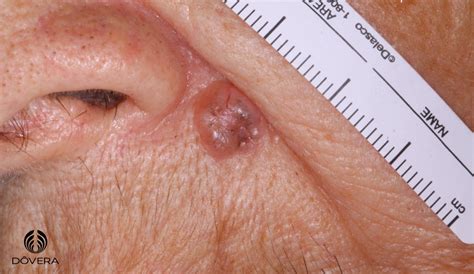 Carcinoma Basocelular Micronodular Diagnóstico E Tratamento