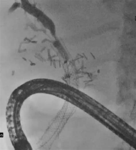 Fluoroscopic Image Showing Bismuth Type Iiia Hilar Stricture Download Scientific Diagram