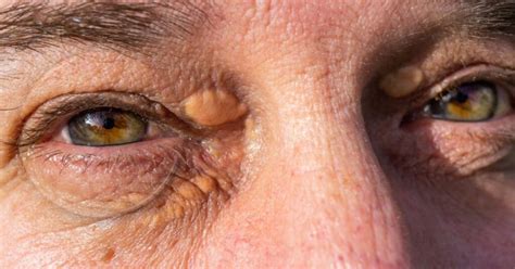 5 Common Signs Of High Cholesterol On Face