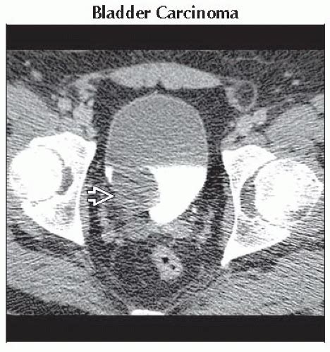 Da17 Db1 Fillingdefectinurinarybladder Ffu1 Abdominal Key