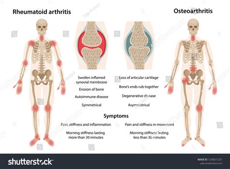 Difference Between Rheumatoid Arthritis Osteoarthritis On Stock Vector