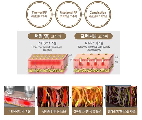 듀엣rf리프팅 닥터린의원 피부과