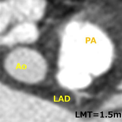 Surgical Observations Schema A Lfc Left Facing Cusp Rfc Right Download Scientific Diagram