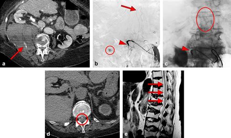 Spinal Cord Ischemia After Lumbar Artery Embolization For