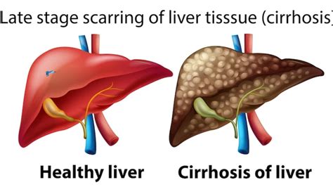 World Liver Day 2023 Stages Of Liver Cirrhosis And Its Management