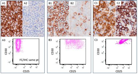 Low Cd25 In Alk Anaplastic Large Cell Lymphoma Is Associated With