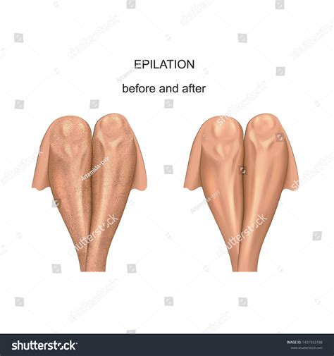 Vector Illustration Legs Before After Hair Stock Vector Royalty Free Shutterstock