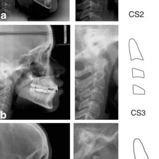 Correlation Of Hand Wrist And CVM Stages Download Table