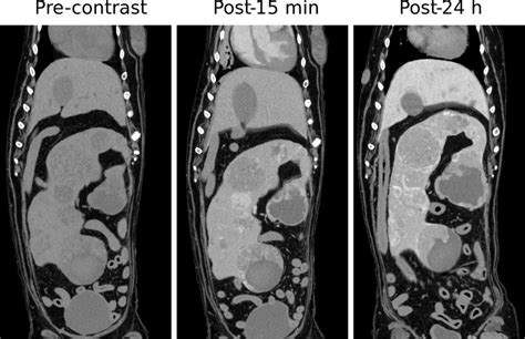 Imaging Of Splenic Hemangiosarcoma Coronal Images Demonstrating