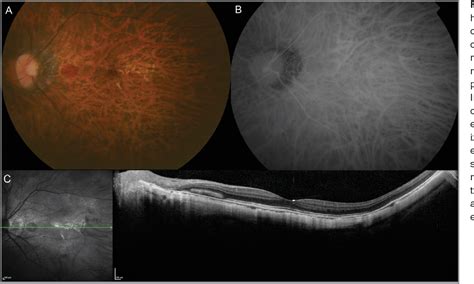 Figure 2 From How To Differentiate Myopic Choroidal Neovascularization Idiopathic Multifocal