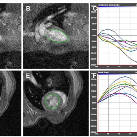 Cine Cmr Images Without And With Endocardial Contouring And Examples Of