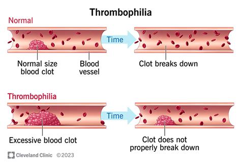 Thrombophilia Symptoms And Treatment