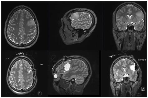 Pre And Postoperative Magnetic Resonance Imaging Mri Of Patient Download Scientific Diagram