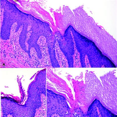 Histopathological Examination A The Obliquely Oriented Cornoid