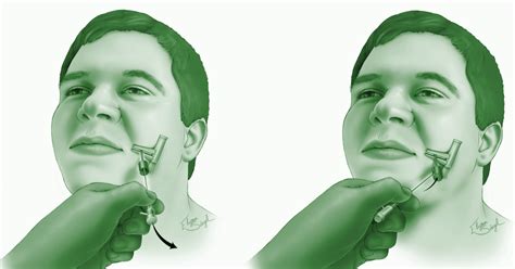 Icd 10 Code For Trigeminal Neuralgia Mytrigeminalneuralgia