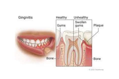 What Is Gingivitis