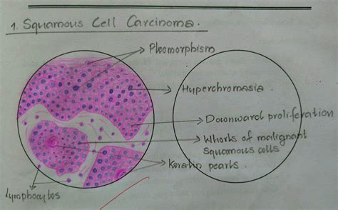 Squamous Cell Carcinoma Histology Labeled Squamous Cell Carcinoma Histology Labeled