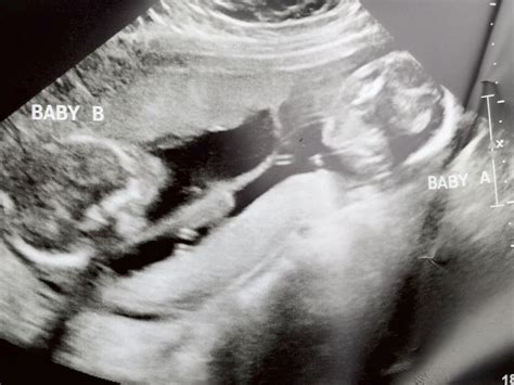 20 Weeks Pregnant With Twins Ultrasound 20 Weeks Pregnant With Twins