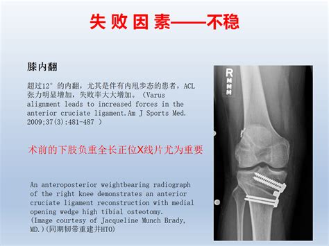 Acl为什么会重建失败，看看这篇！ 好医术早读文章 好医术 赋能医生守护生命