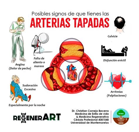 Signos De Que Tienes Las Arterias Tapadas