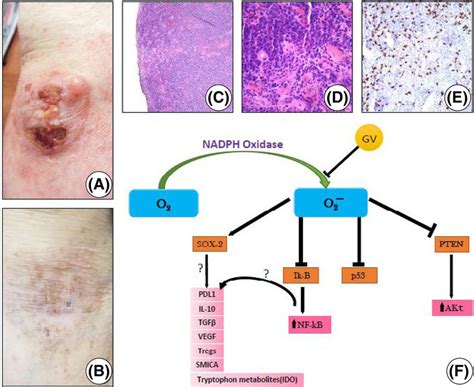 Primary Cutaneous Diffuse B Cell Lymphoma Leg Type A Clinical