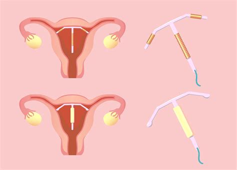 Iud Myths Busting Pregnancy Myths Types Of Iud Birth Control Myths Herzindagi