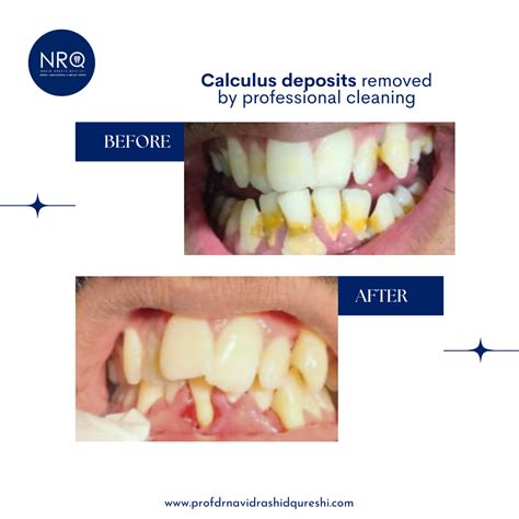 Calculus Deposits Lead To Gum Disease Drprofnavidqureshi Medium