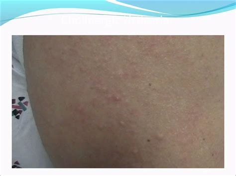 Clinical Approach To Urticaria And Angiodema Ppt Skin And Dermatology Diseases And Conditions
