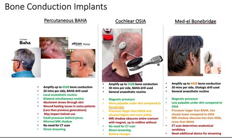Bone Conduction Hearing Implants Good Comparison July 2023 R Monohearing